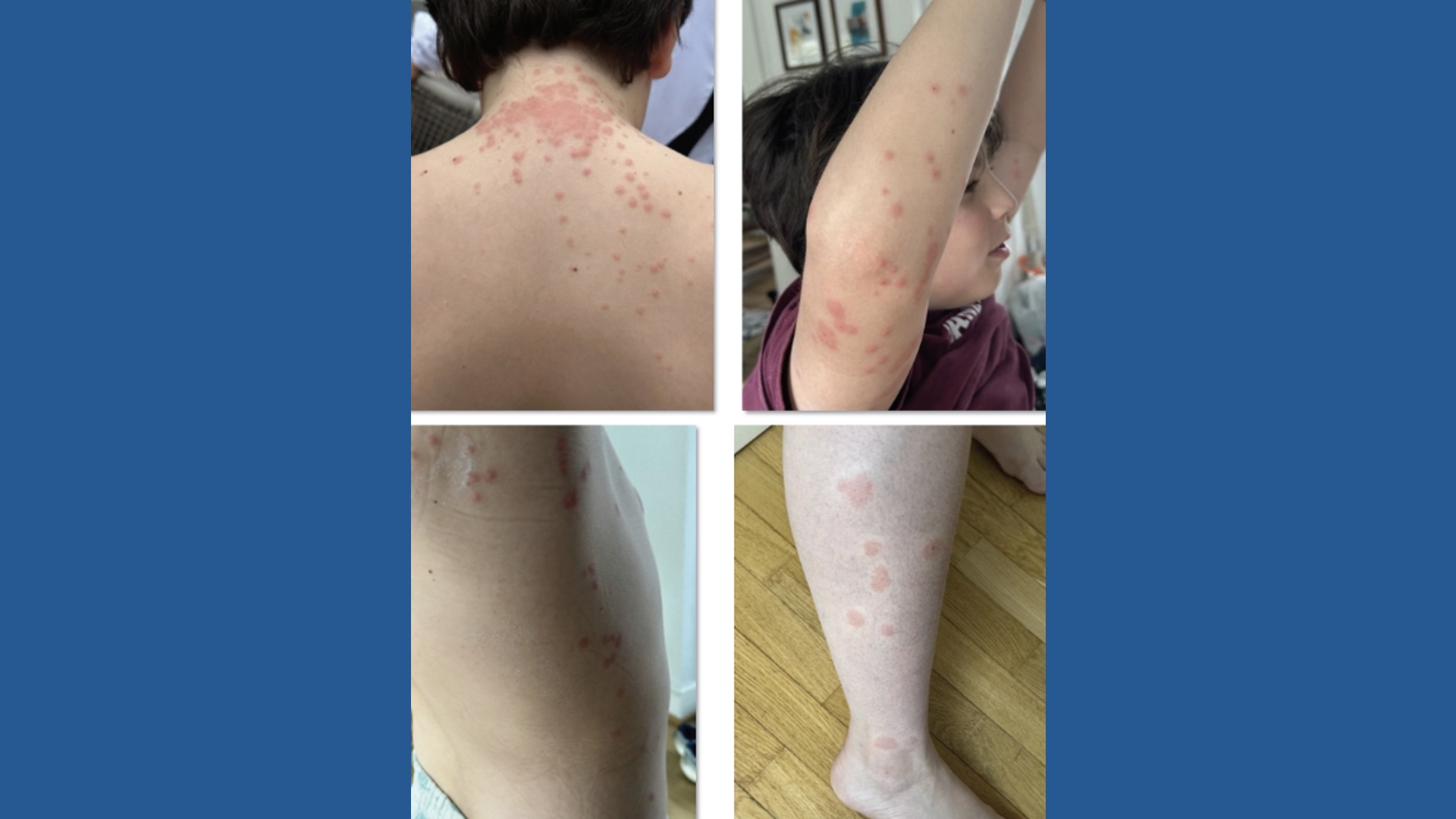 Family sues Delta, KLM, claiming their flight was infested with bed ...